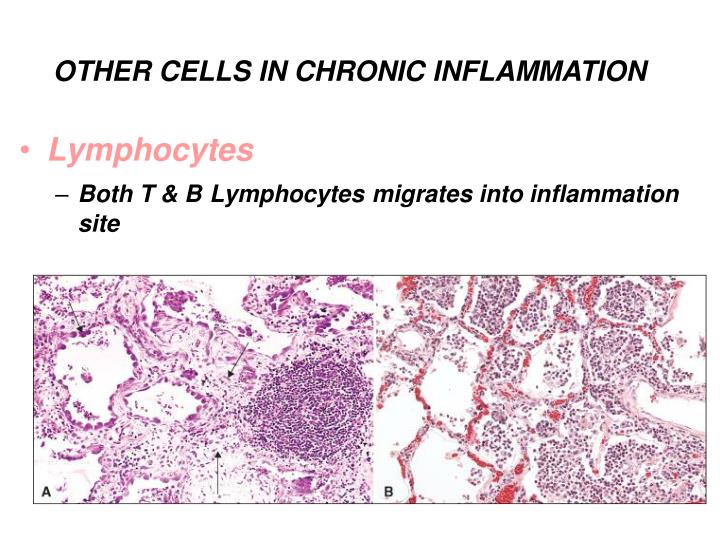 PPT - INFLAMMATION AND REPAIR Lecture 4 Chronic inflammation Systemic ...