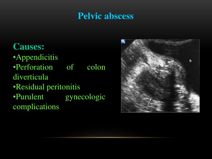 PPT - ACUTE PERITONITIS PowerPoint Presentation - ID:6064315