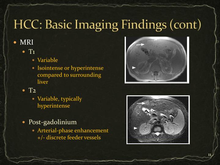 PPT - Understanding Hepatocellular Carcinoma (HCC) - A General Intro to ...