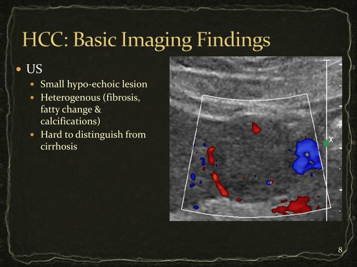 PPT - Understanding Hepatocellular Carcinoma (HCC) - A General Intro to ...