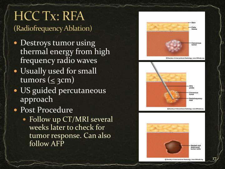 PPT - Understanding Hepatocellular Carcinoma (HCC) - A General Intro to ...
