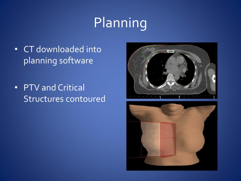 PPT - Radiation Therapy: The Breast Cancer Patient Experience ...
