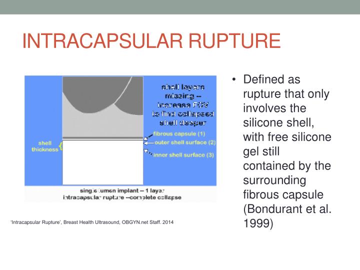 PPT - BREAST IMPLANT RUPTURE PowerPoint Presentation - ID:6071273
