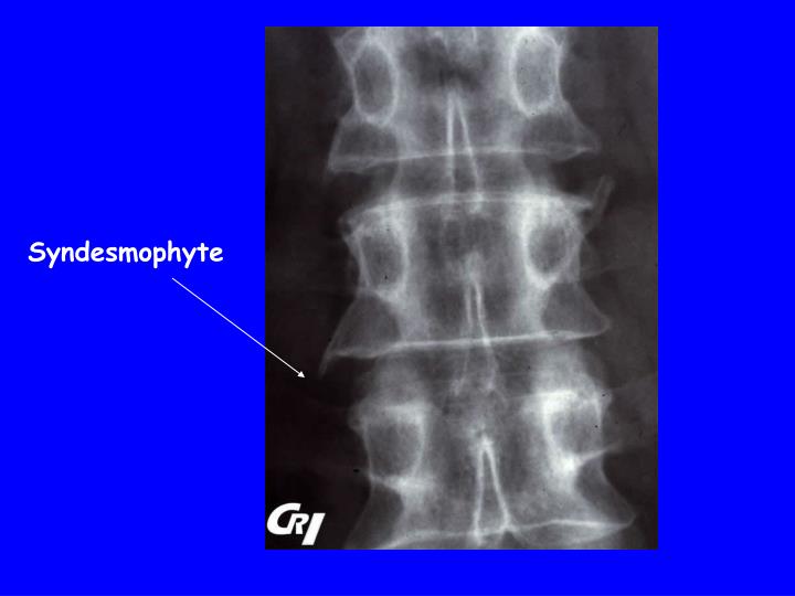 PPT - SPONDYLARTHROPATHIES PowerPoint Presentation - ID:6076371