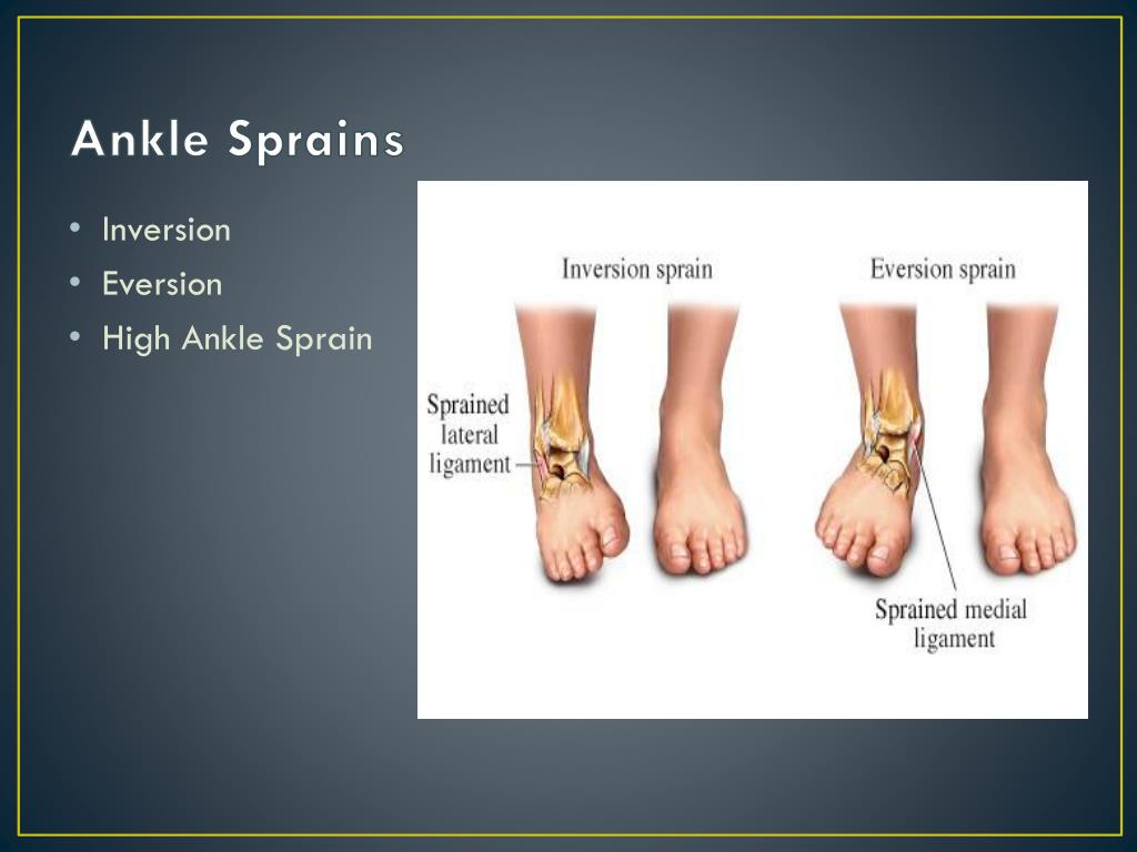 PPT - Injuries to the Foot, Ankle and Lower Leg PowerPoint Presentation ...