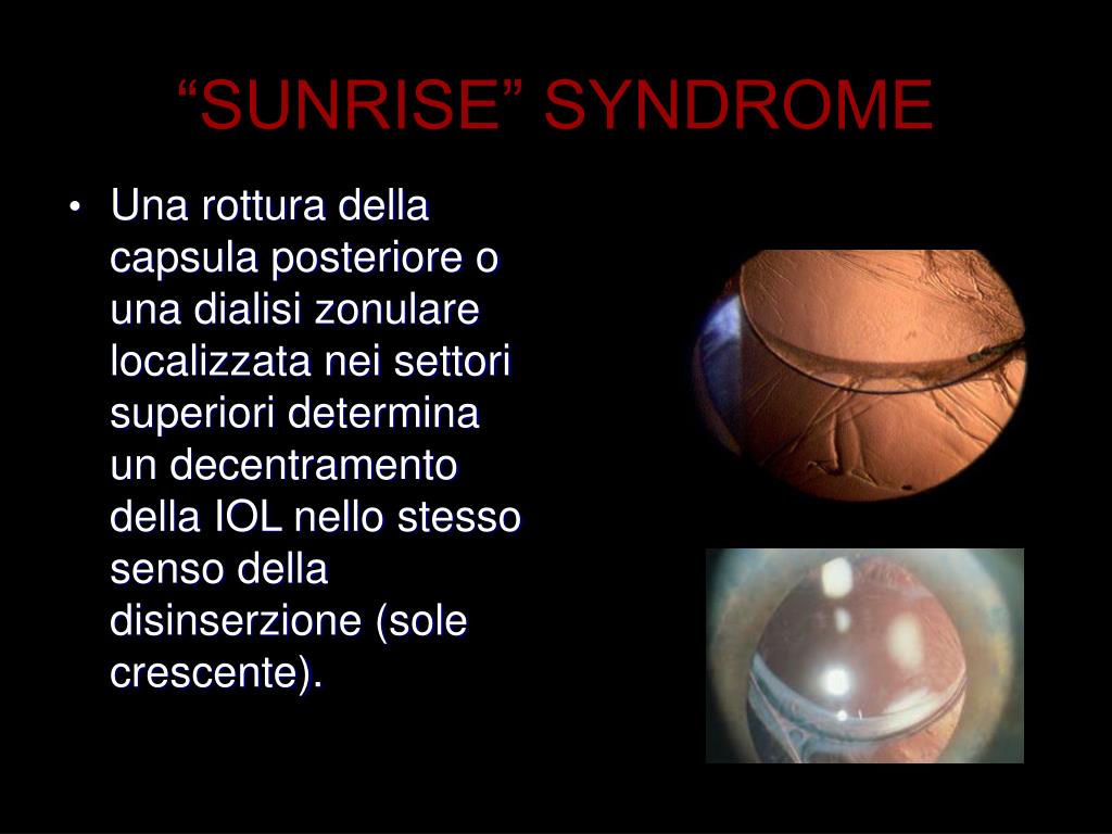 PPT - 3° LIVE SURGERY DEL MEDITERRETINA CLUB 14-14 Aprile 2011 GESTIONE ...
