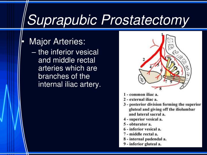 PPT - GU Procedures Operative Sequence PowerPoint Presentation - ID:6084441