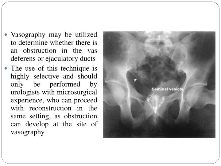 PPT - Updates on the evaluation and management of Azoospermia ...