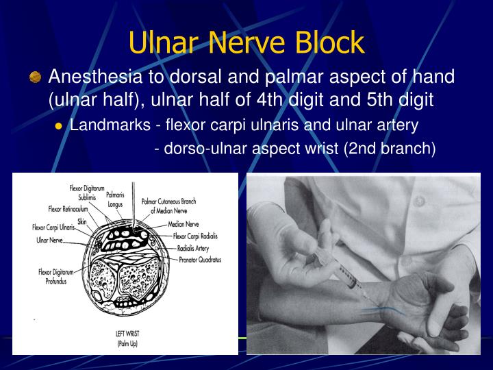 PPT - Nerve Blocks PowerPoint Presentation - ID:6088129