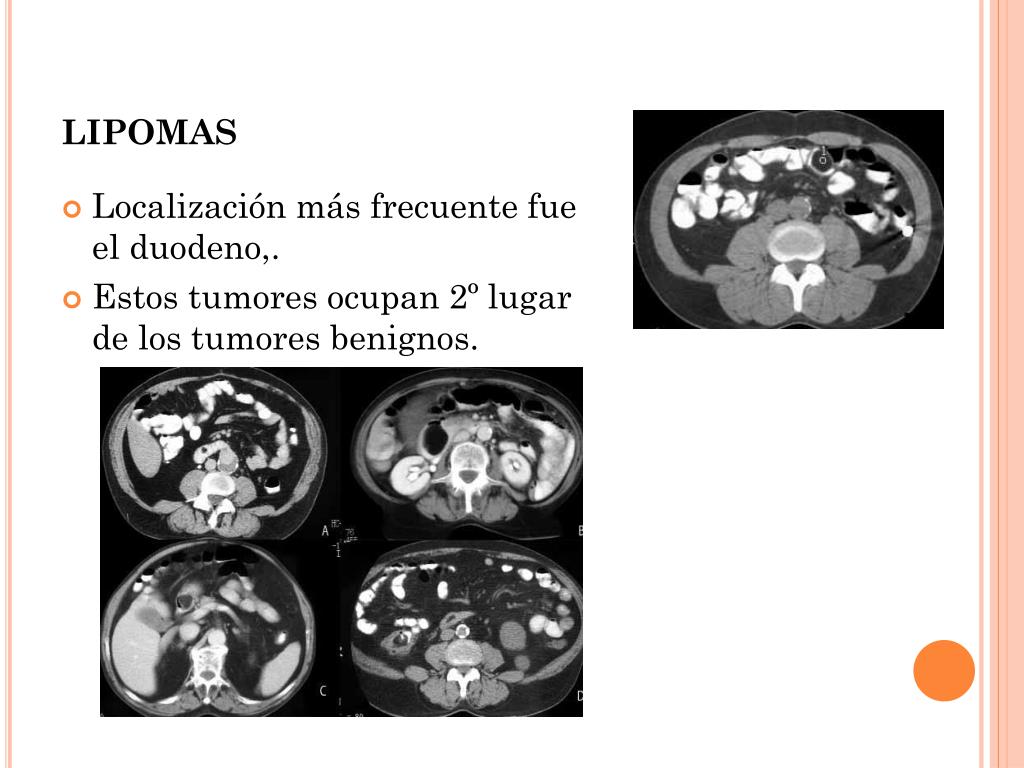 PPT - TRASTORNOS VASCULARES INTESTINALES Y TUMORACIONES DE INTESTINO ...