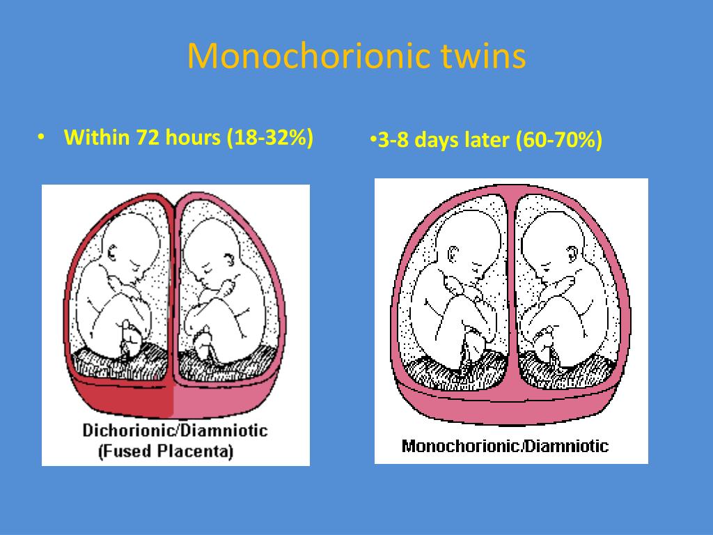 Ppt Multifetal Pregnancy Powerpoint Presentation Free Download Id