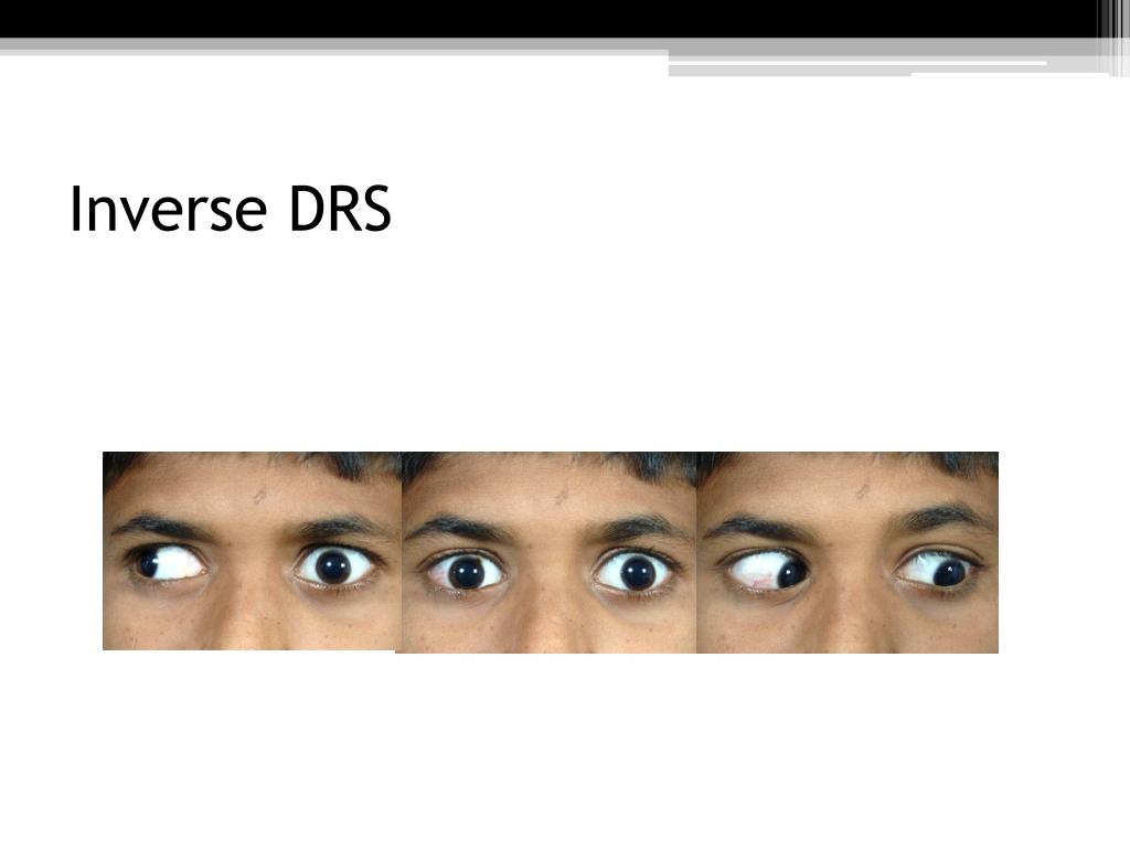 PPT - Duane’s Retraction Syndrome PowerPoint Presentation, free ...