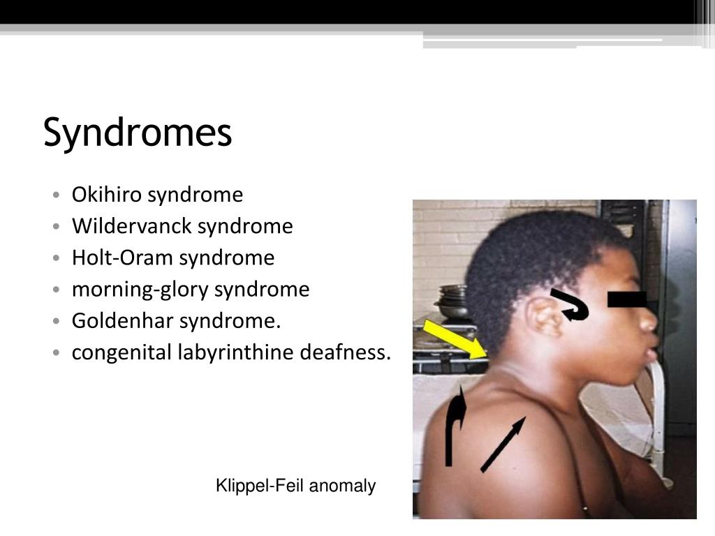 PPT - Duane’s Retraction Syndrome PowerPoint Presentation, free ...