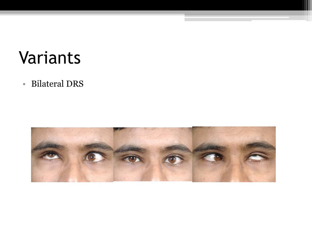 PPT - Duane’s Retraction Syndrome PowerPoint Presentation, free ...