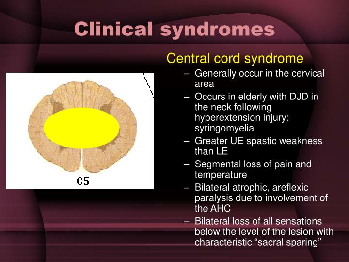 PPT - Spinal Cord Injury PowerPoint Presentation - ID:6094142