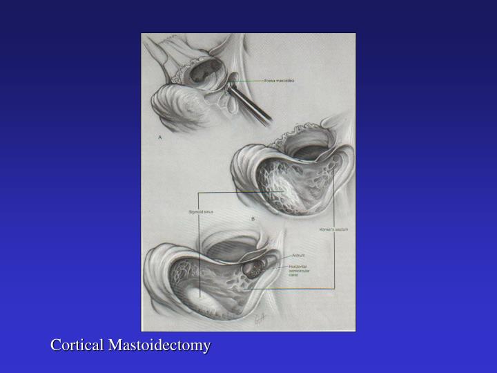 PPT - Cortical Mastoidectomy and Combined Approach Tympanoplasty (CAT) PowerPoint Presentation ...