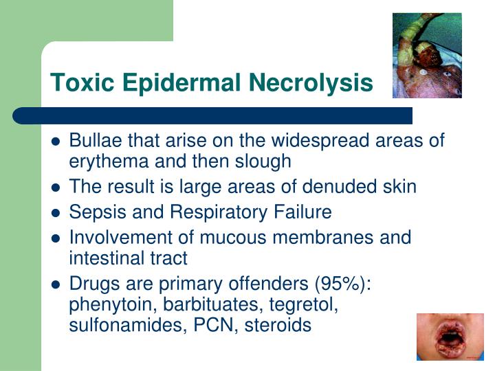 PPT - Blistering Skin Eruptions PowerPoint Presentation - ID:6097124