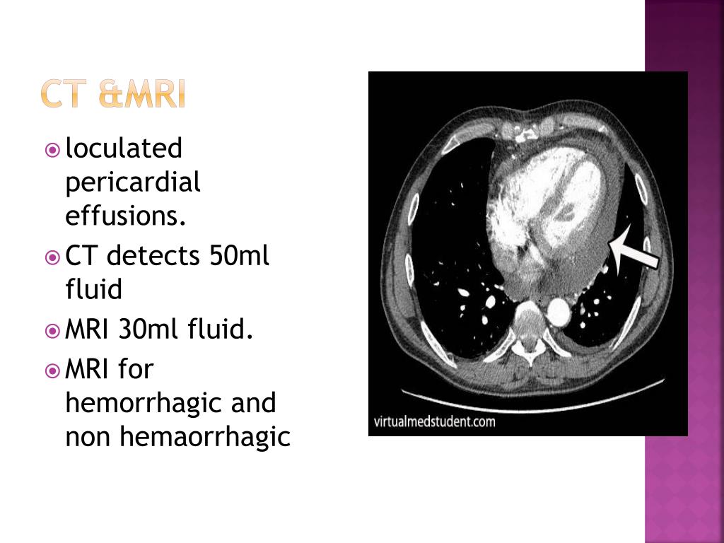 PPT - Pericardial effusion and Cardiac tamponade PowerPoint ...