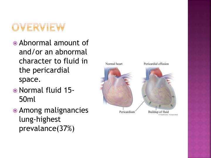 PPT - Pericardial effusion and Cardiac tamponade PowerPoint ...