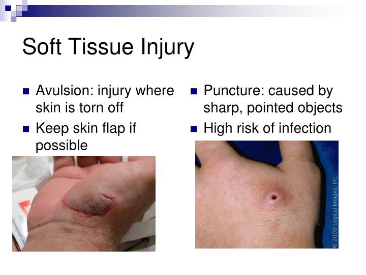 PPT - Chapter 11 Assessment and Evaluation of Sports Injuries ...