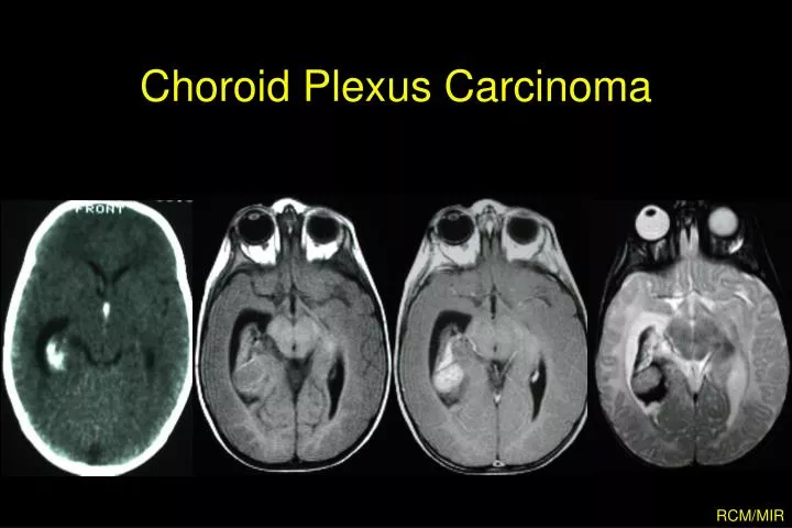 PPT - Choroid Plexus Carcinoma PowerPoint Presentation, free download ...