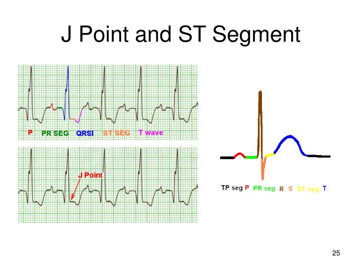 PPT - Perioperative Hypotension and Myocardial Ischemia PowerPoint ...