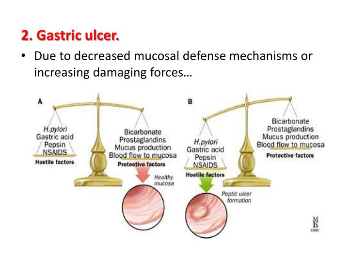 PPT - PEPTIC ULCER disease (PUD) Pathophysiology PowerPoint ...