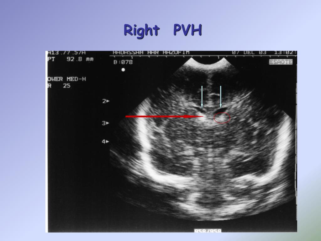 PPT - Intra Cerebral Hemorrhage ד"ר עפרה פלג טיפול נמרץ ביילוד הדסה ...