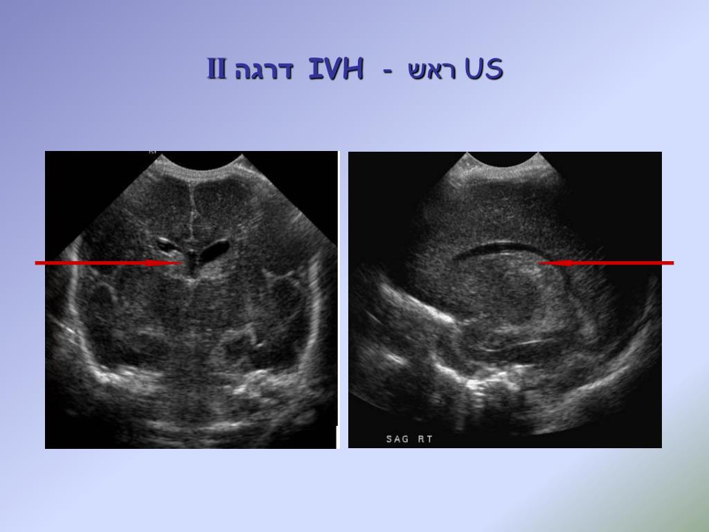 PPT - Intra Cerebral Hemorrhage ד"ר עפרה פלג טיפול נמרץ ביילוד הדסה ...