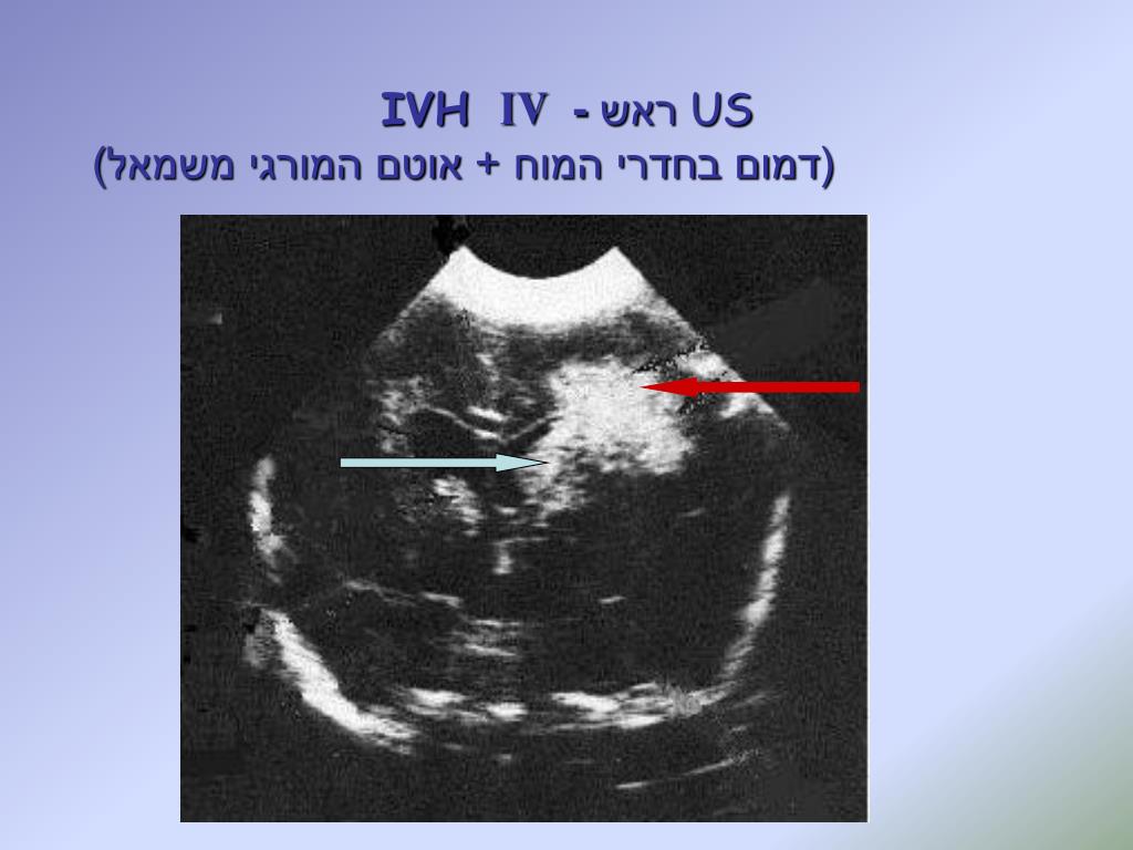 PPT - Intra Cerebral Hemorrhage ד"ר עפרה פלג טיפול נמרץ ביילוד הדסה ...