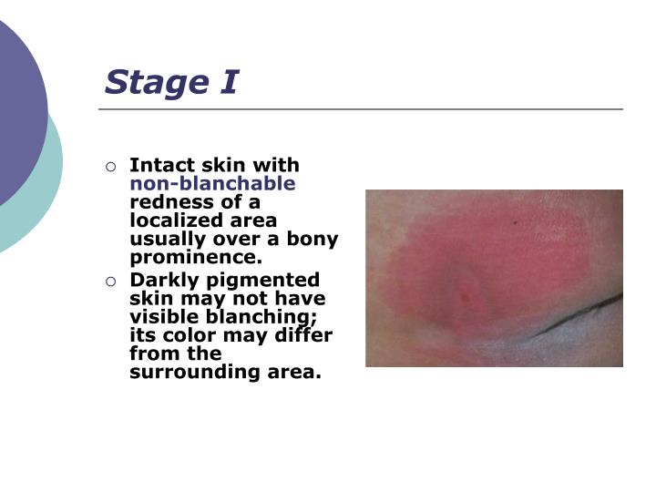 PPT - PRESSURE ULCER STAGING PowerPoint Presentation - ID:6113428