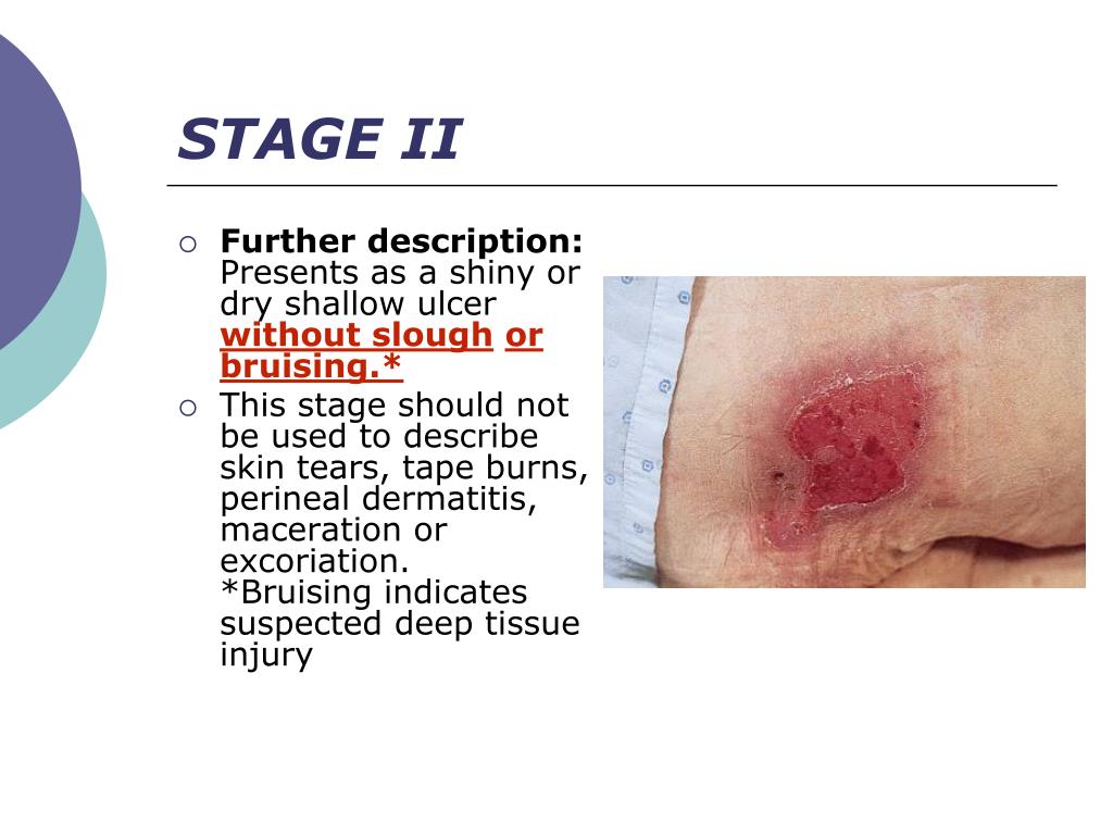 Pressure Ulcer Staging Vrogue co Pressure Ulcer Staging Vrogue co