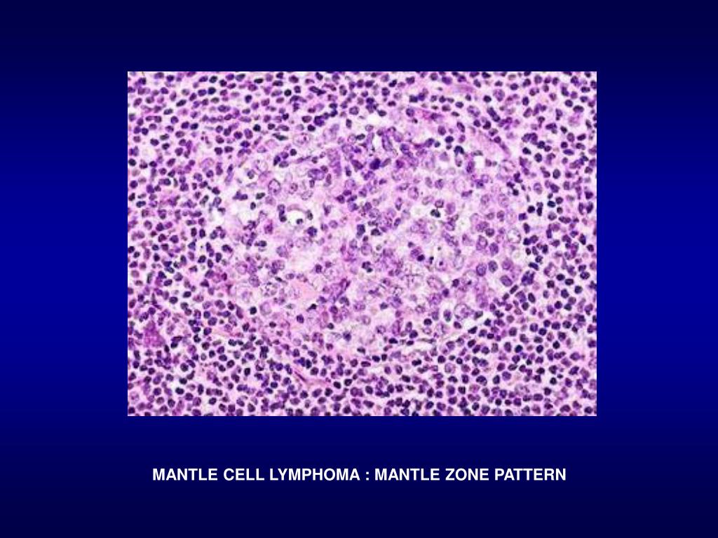 PPT - LINFOMA MANTELLARE : DALLA PATOGENESI MOLECOLARE AGLI ASPETTI ...