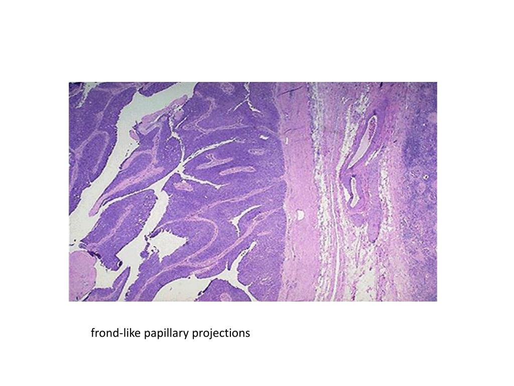PPT - Urothelial CA: Cancers of the Bladder, Ureter, and Renal Pelvis ...