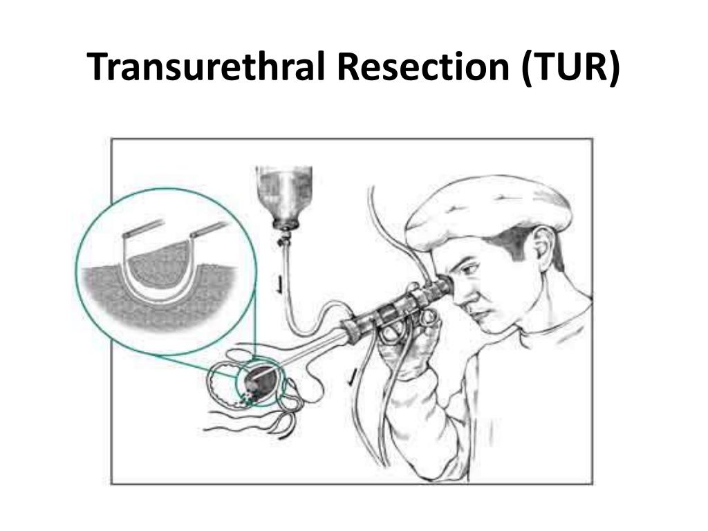 PPT - Urothelial CA: Cancers of the Bladder, Ureter, and Renal Pelvis ...