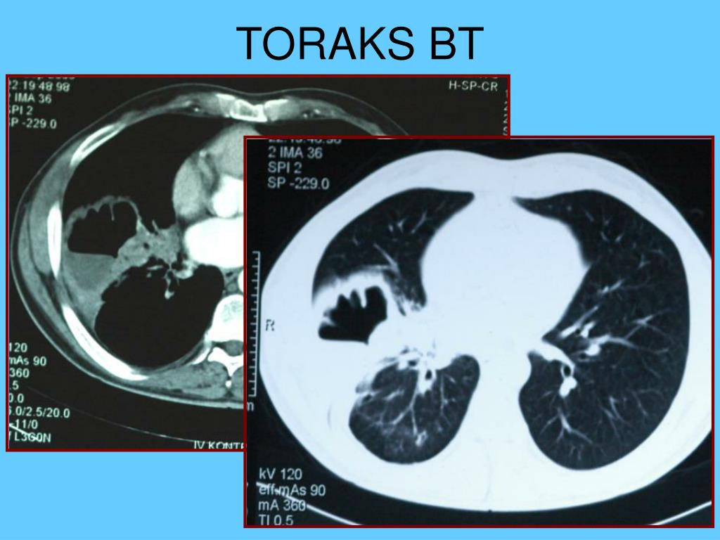 PPT - OLGU SUNUMU PowerPoint Presentation, free download - ID:6122262