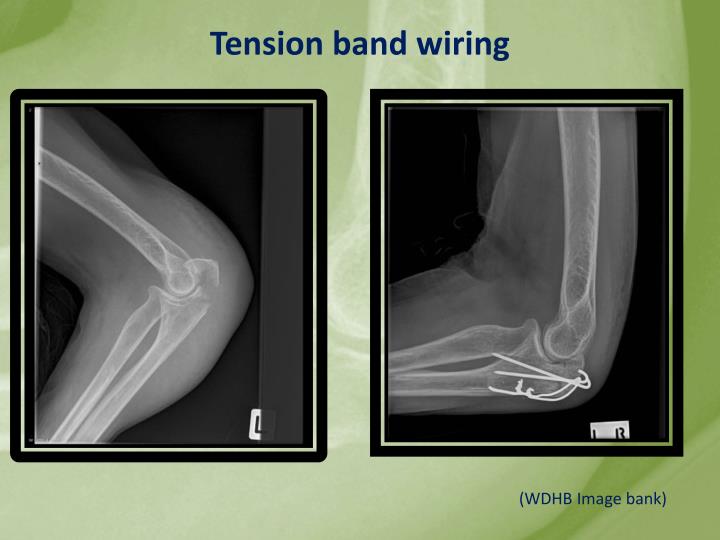 PPT - Olecranon fractures PowerPoint Presentation - ID:6125543