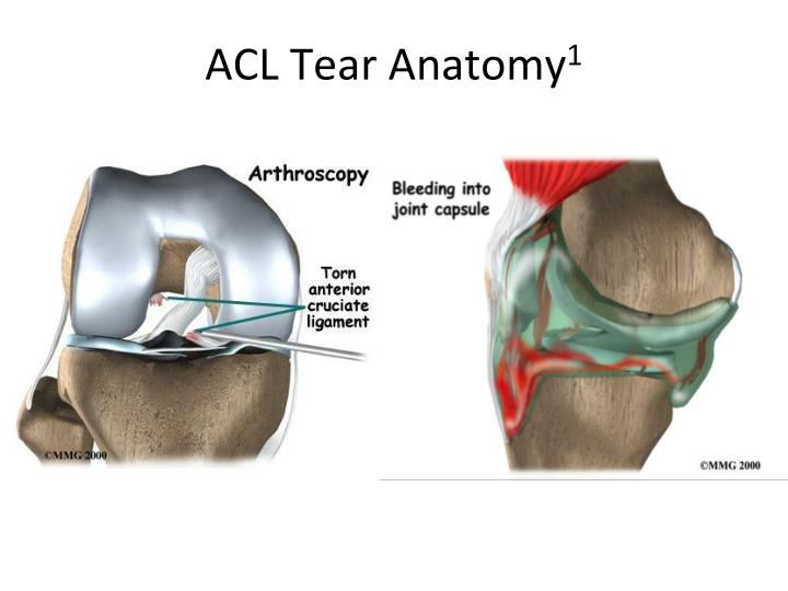PPT - ACL Reconstruction PowerPoint Presentation - ID:6134015
