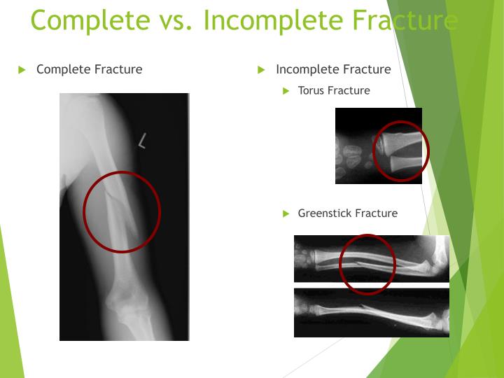 PPT - Orthopedics Injury PowerPoint Presentation - ID:6134100
