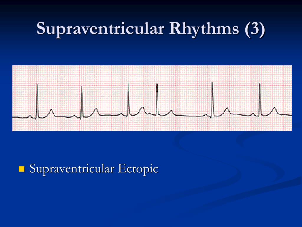 PPT The Basics Of ECG Interpretation PowerPoint Presentation Free