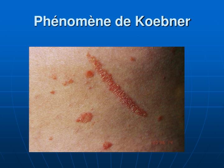PPT - PSORIASIS PowerPoint Presentation - ID:6161970