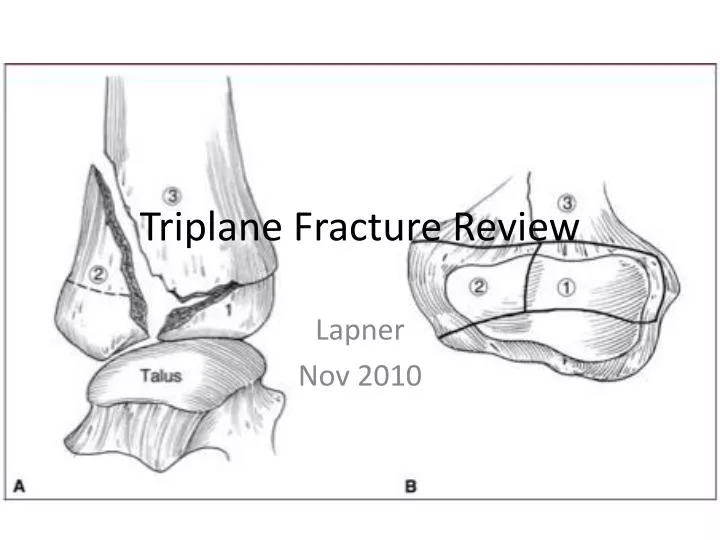 PPT - Triplane Fracture Review PowerPoint Presentation - ID:6163481
