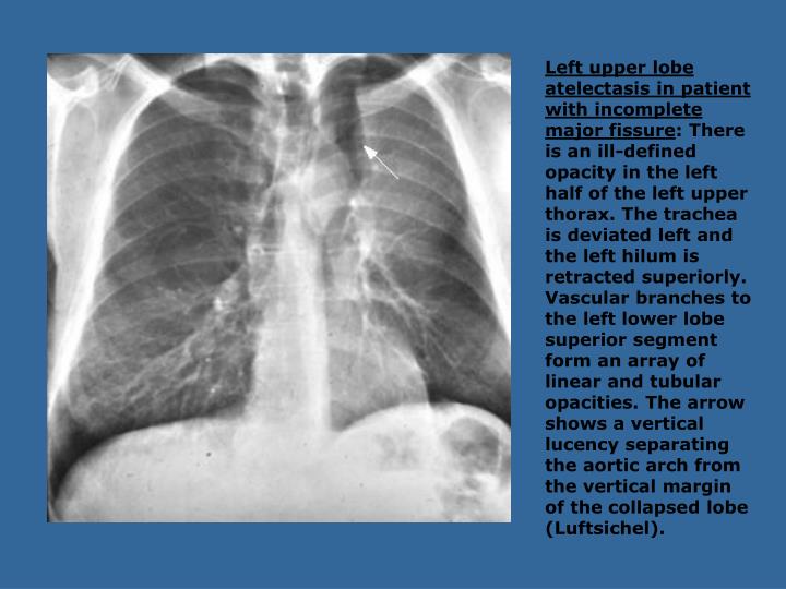 PPT - Atelectasis PowerPoint Presentation - ID:6185976