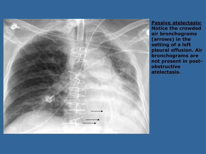 PPT - Atelectasis PowerPoint Presentation - ID:6185976