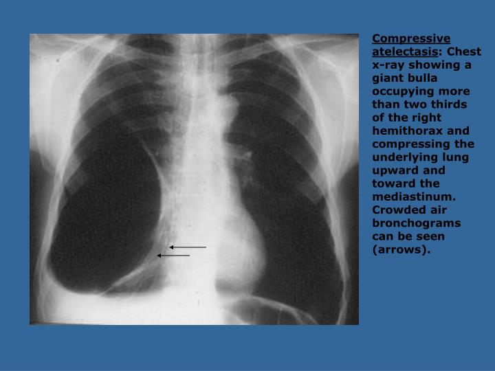 PPT - Atelectasis PowerPoint Presentation - ID:6185976