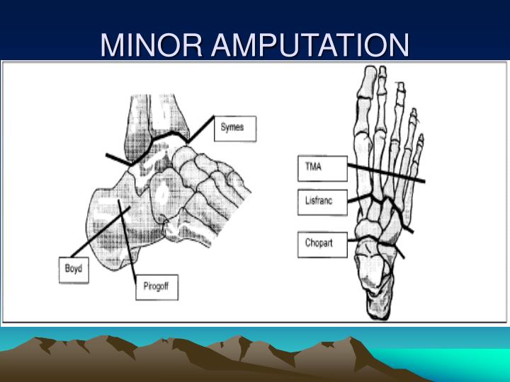 PPT - AMPUTATIONS IN DIABETIC FOOT PowerPoint Presentation - ID:6191352