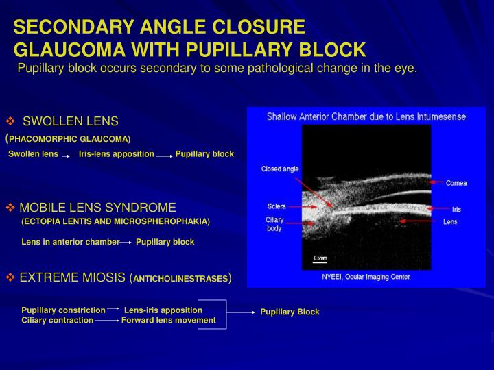 PPT - ANGLE-CLOSURE GLAUCOMA PowerPoint Presentation - ID:6217582