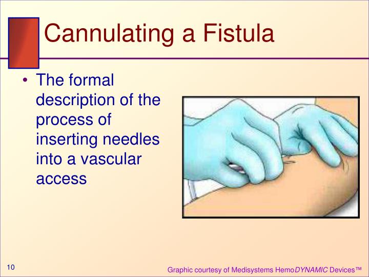 PPT - Cannulation of the Arteriovenous Fistula (AVF) PowerPoint ...