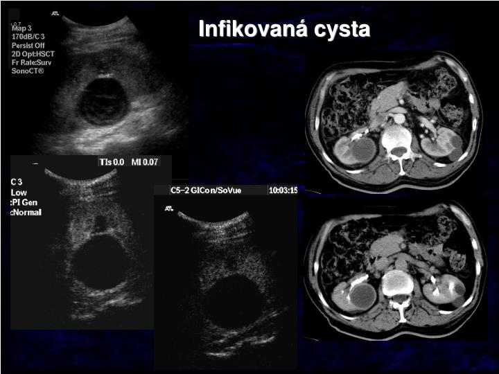 PPT - Ložiskové procesy ledvin PowerPoint Presentation - ID:6228178