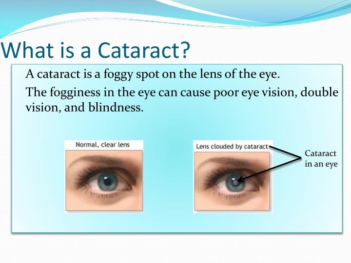 PPT - Cataract Symptoms PowerPoint Presentation - ID:6233269